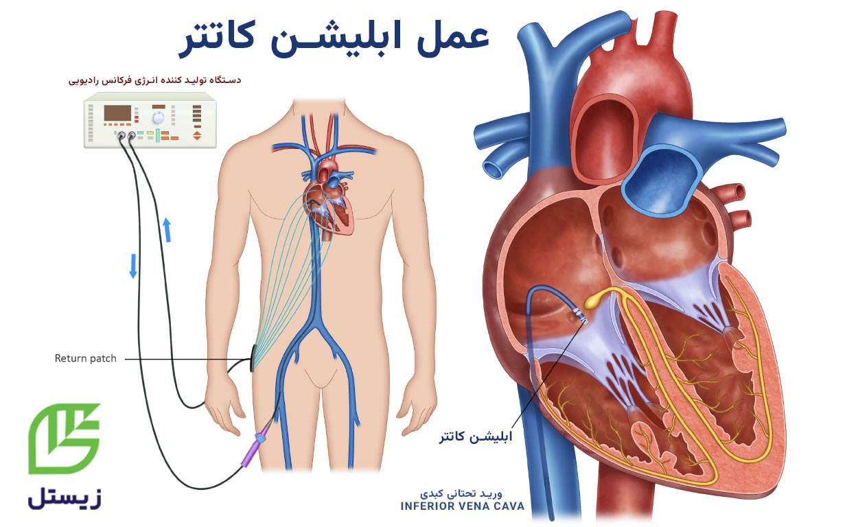 ابلیشن قلب _ عوارض و مراقبت های بعد از آن | زیستل